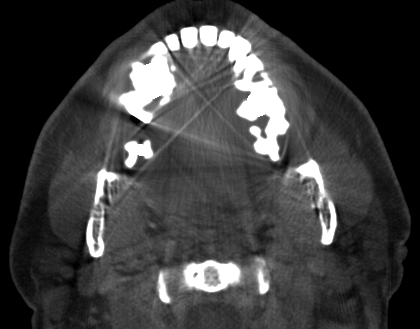 ReVision Radiology: CT metal artifact reduction using the Metal Deletion Technique (MDT)